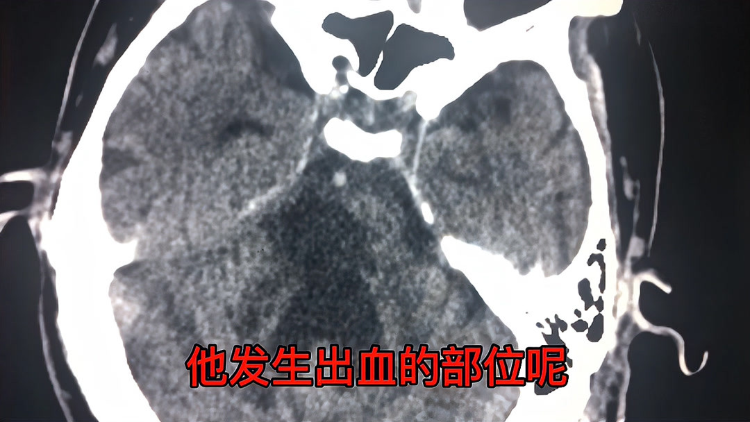 30多岁脑干出血变成植物人,年轻的高血压患者,你还敢不吃药吗?