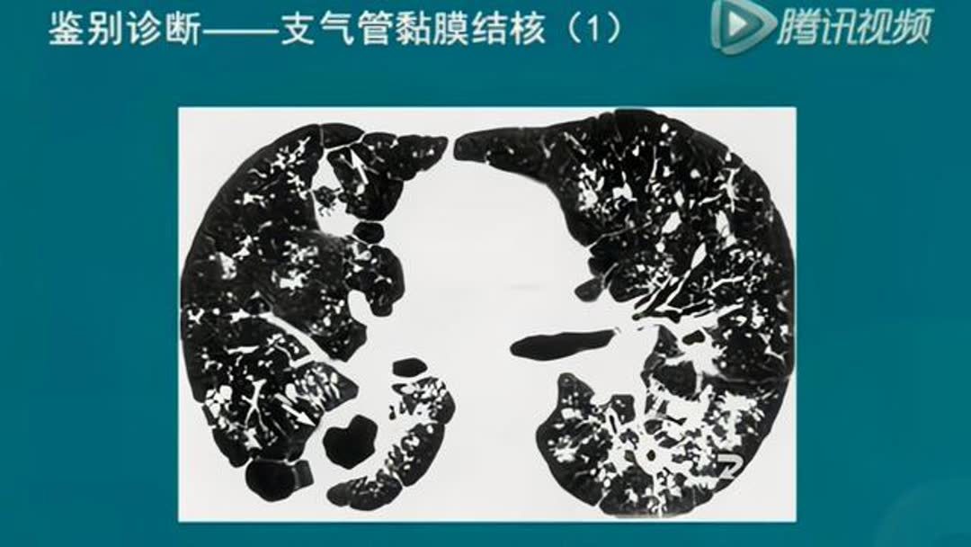 【精品-胸部:肺病变】支气管扩张的影像诊断