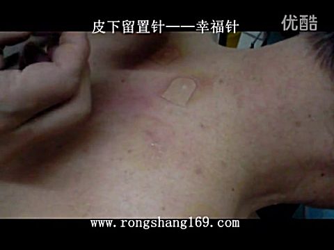 无痛皮下留置针疗法治疗颈椎病