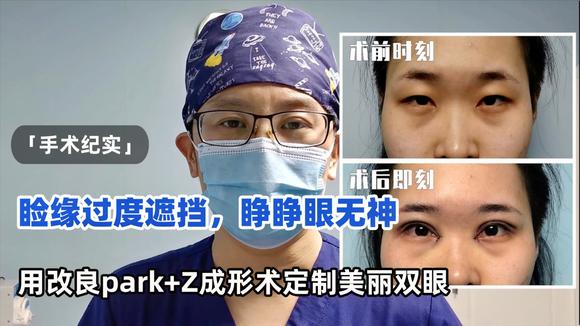 睑缘过度遮挡,睁眼无神,用改良park+Z成形术定制美丽双眼