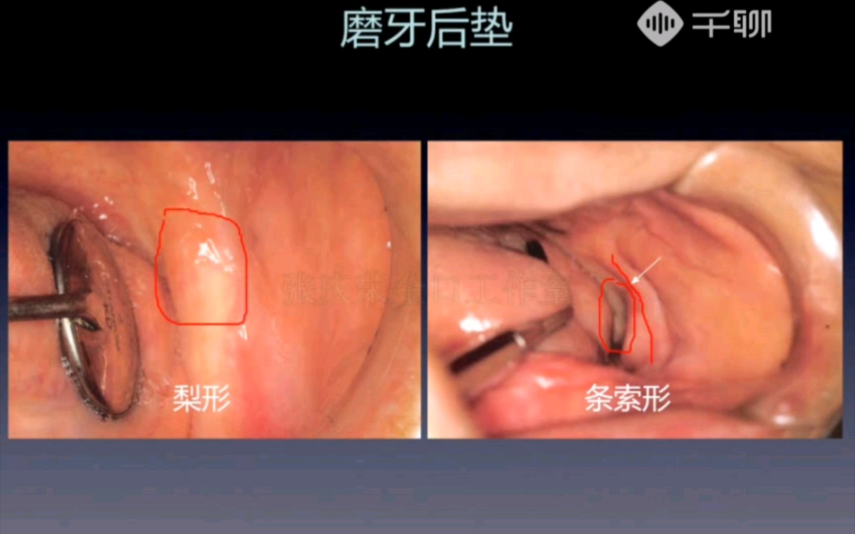 义齿初印模制取方法(2)