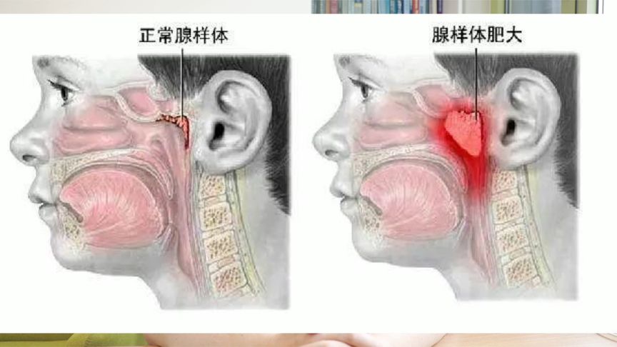 打鼾会不会让孩子变丑?