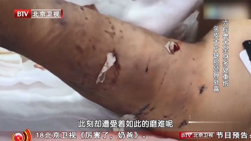 生命缘:六旬老太被动物咬伤,多处重伤,头皮大片缺损