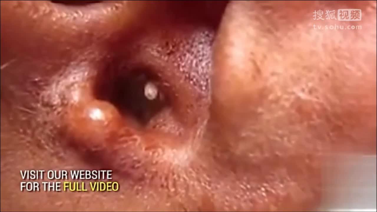 恶心!耳中取出多条蛆虫