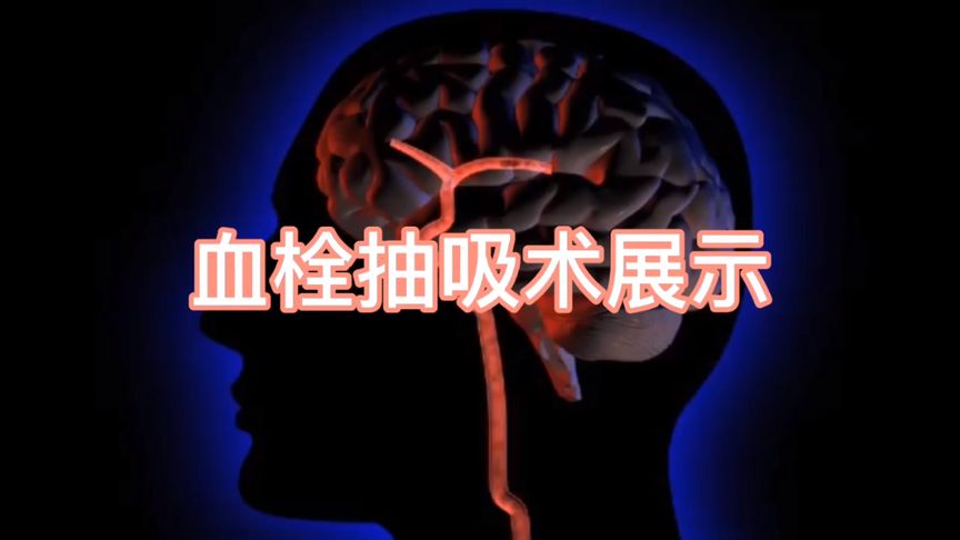 血栓抽吸术动画展示,前方高能!