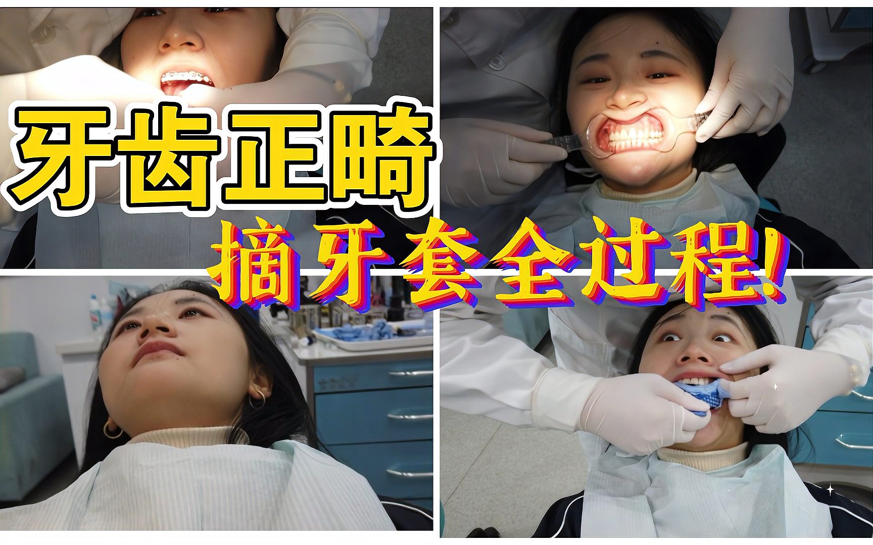 【正畸】开心一刻|摘牙套的全过程|牙齿正畸|取托槽|去树脂|洗牙|牙齿...