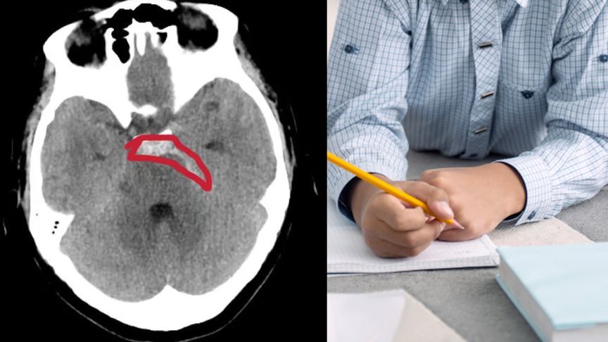 老师辅导女儿作业太激动,头痛恶心查出颅内出血,以为是上班太累