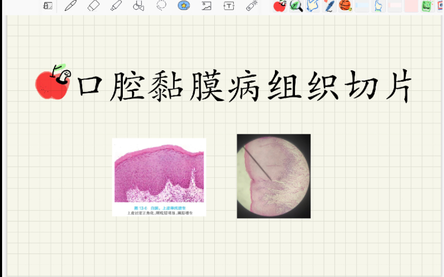 【口组病】口腔黏膜病组织切片