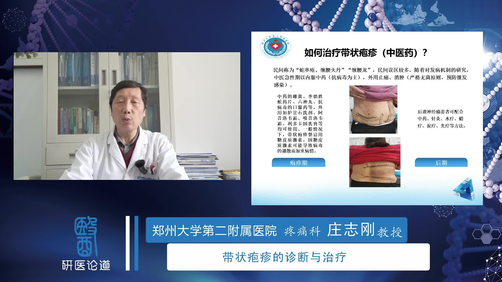 中医药如何治疗带状疱疹?