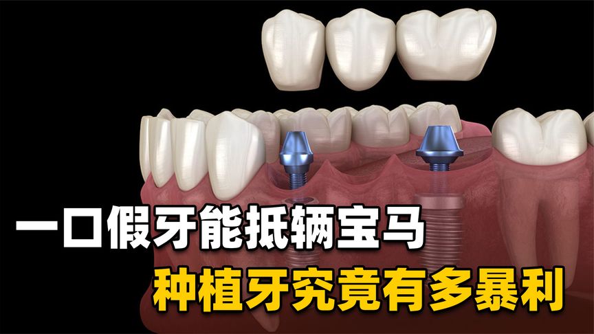 成本百元却卖上万,一口假牙可抵一辆宝马,种植牙为什么这么贵?