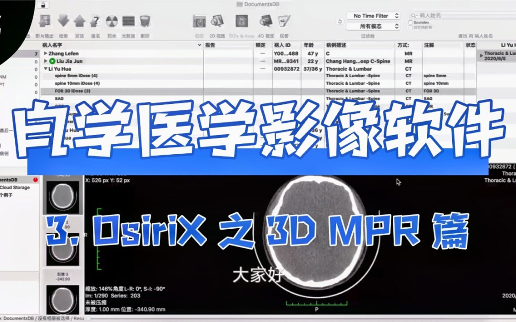 颈椎病群主带你自学医疗影像软件-OsiriX之3D MPR片子多维重建篇