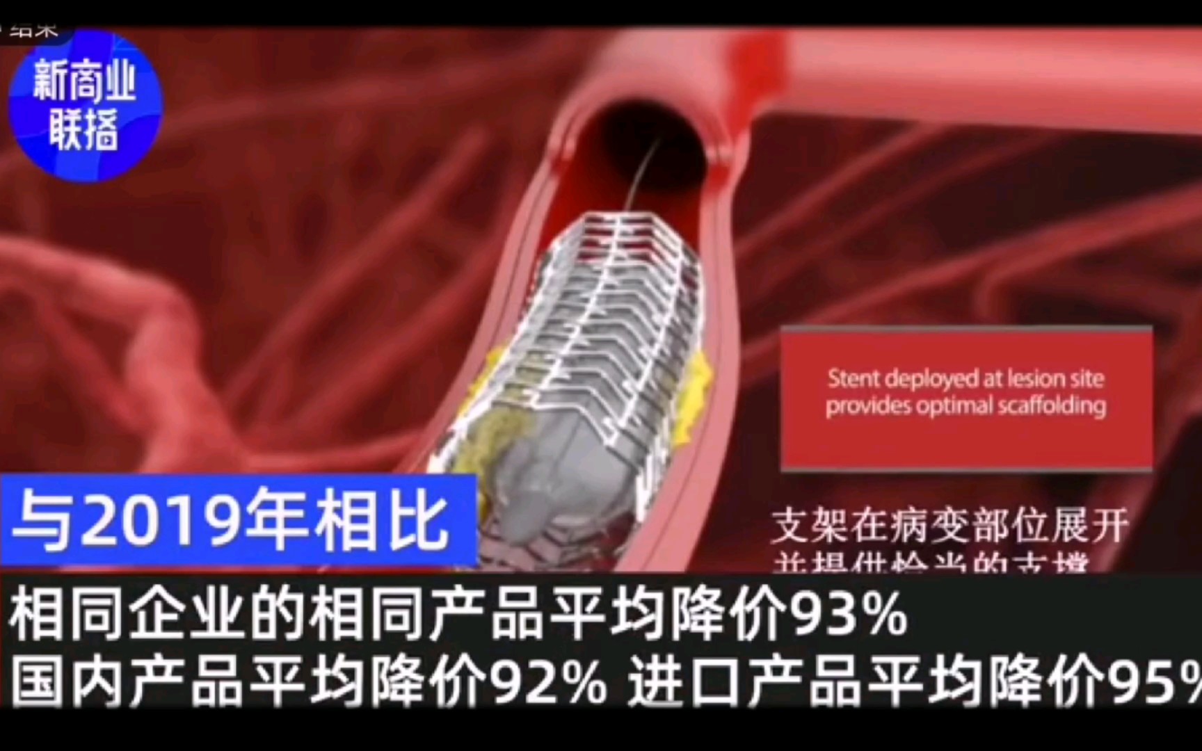 #心脏支架均价降至700元,能放心用吗?