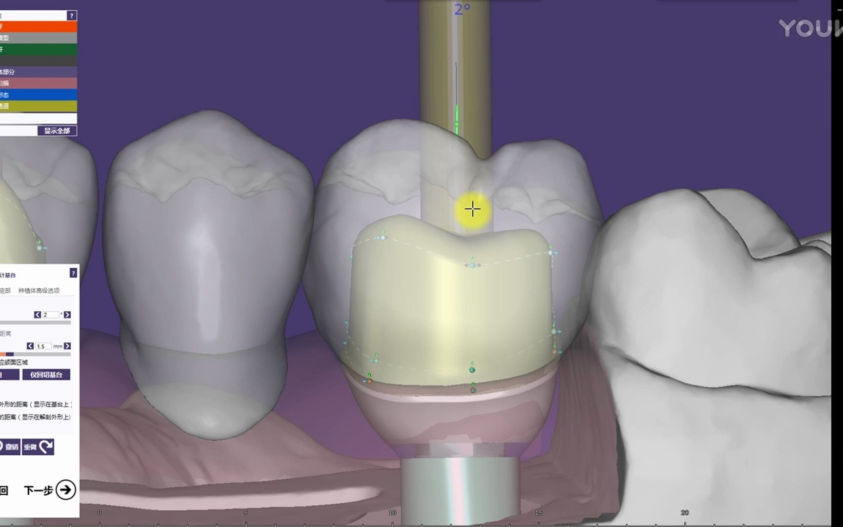 EXOCAD设计流程4-2