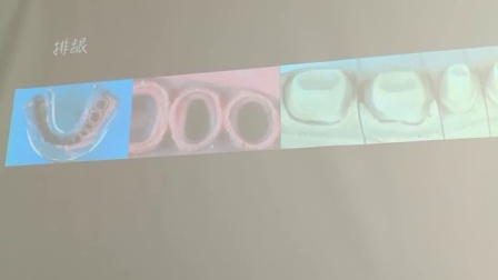 盛世口腔洪世清:如何制取清晰的印模