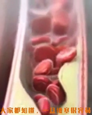 中老年的血管会竟然的堵塞,只要用它,就能够让脑血栓躲着你跑!