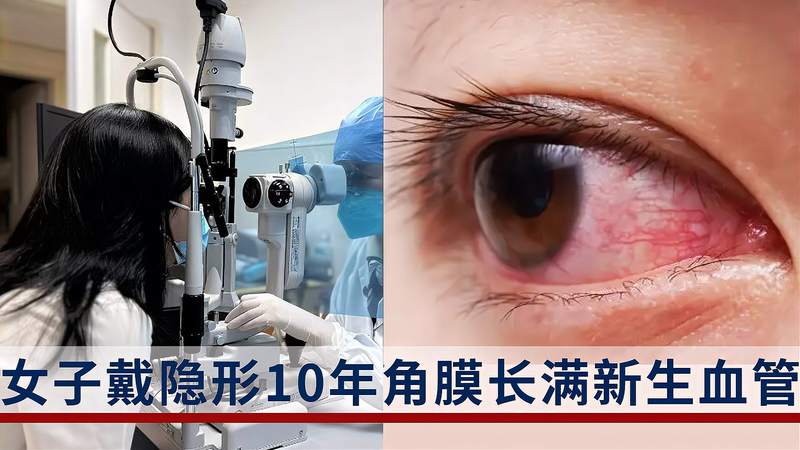 女子戴隐形10年角膜长满新生血管:患有高度近视,每天戴近10小时