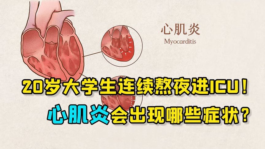 20岁大学生熬夜引起心肌炎!医生:不及时救治,很可能死亡!