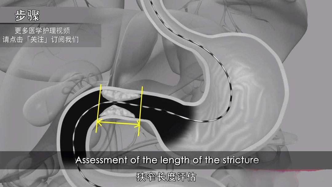 通过幽门支架,医生如何治疗胃癌幽门梗阻的?3D动画演示全过程