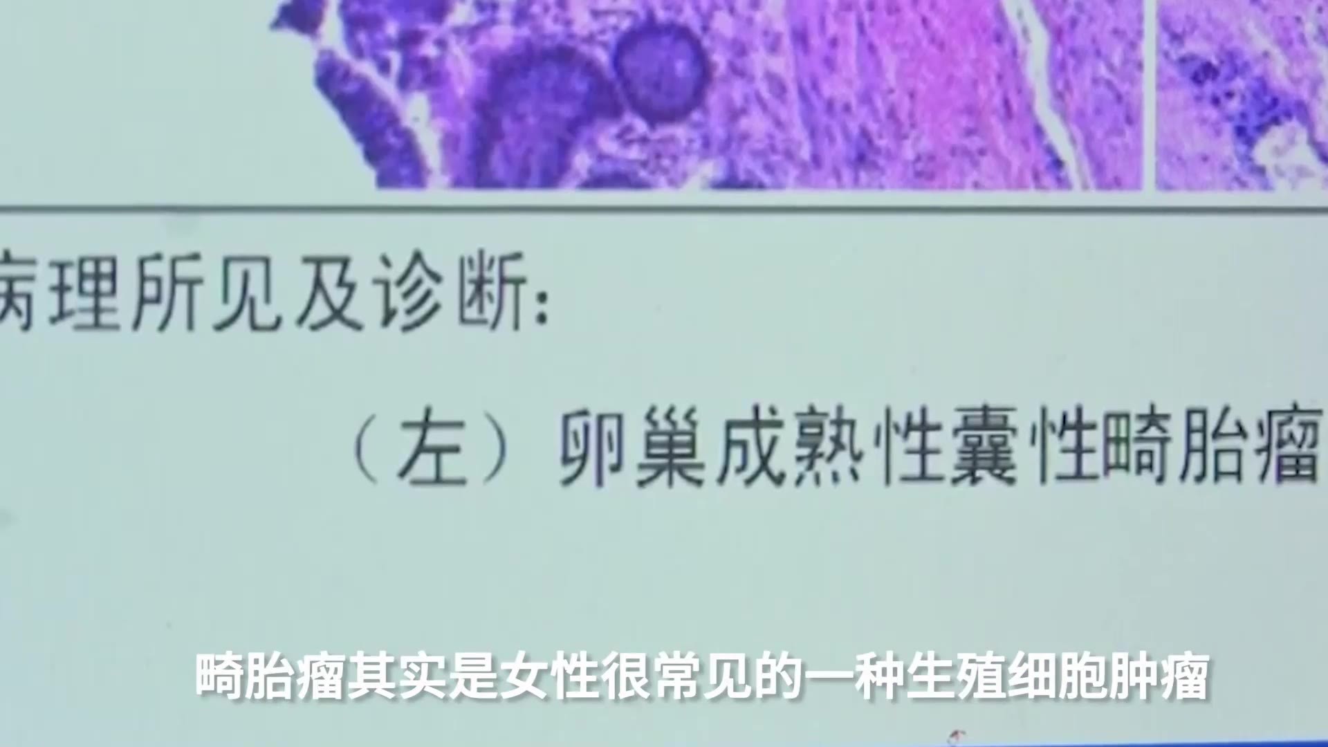 女子体检时发现体内有肿块,医生手术切开后惊了:大量头发和牙齿