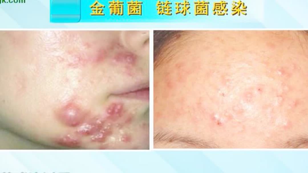 痤疮会导致瘢痕吗?看看医生怎么说
