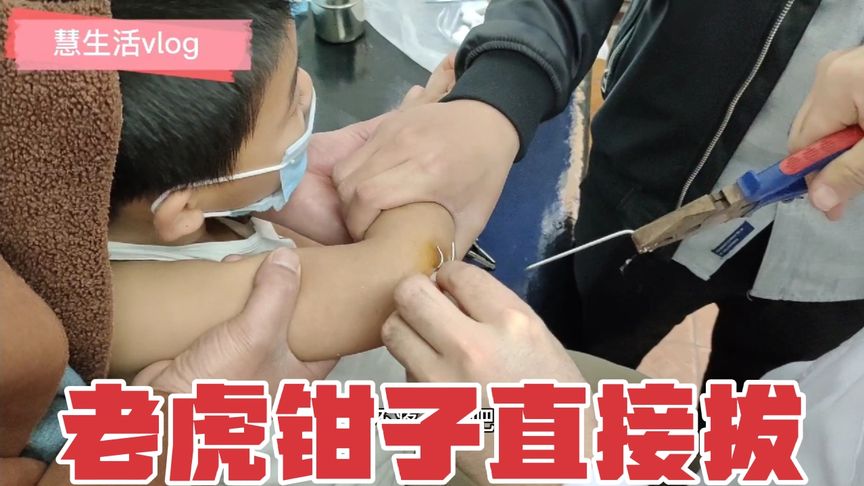 孩子术后复查取钉,不打麻药,老虎钳子直接拔,大人看了都害怕