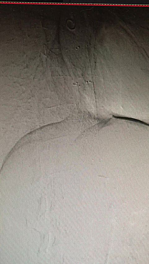 多层裸支架释放后造影图像