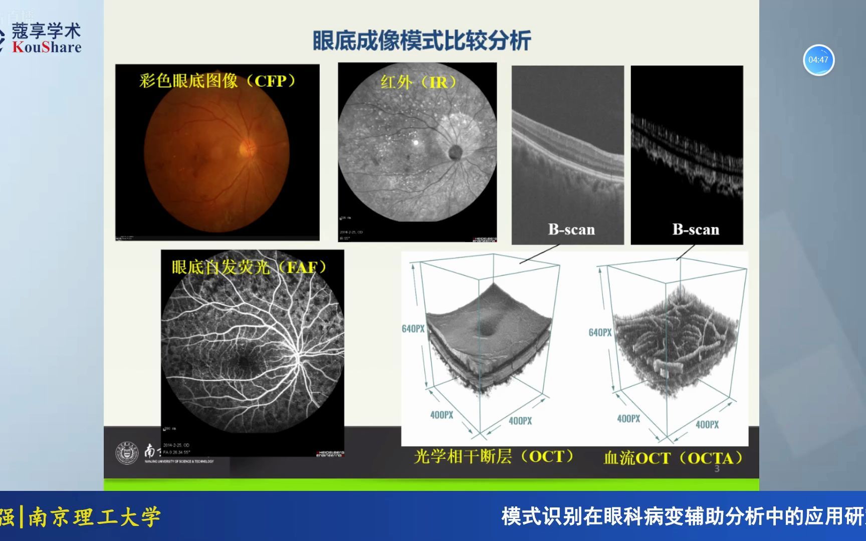 模式识别在眼科病变辅助分析中的应用研究+报告人陈强