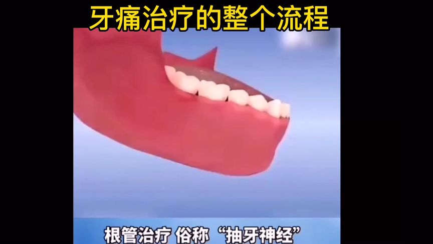根管治疗原来只这样做的!