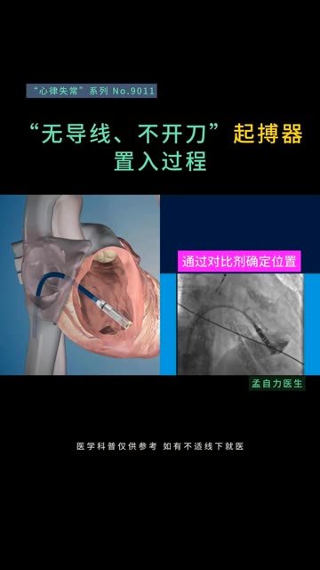 “无导线 不开刀”起搏器置入术 #起搏器 #心律失常 #快手光合计划...