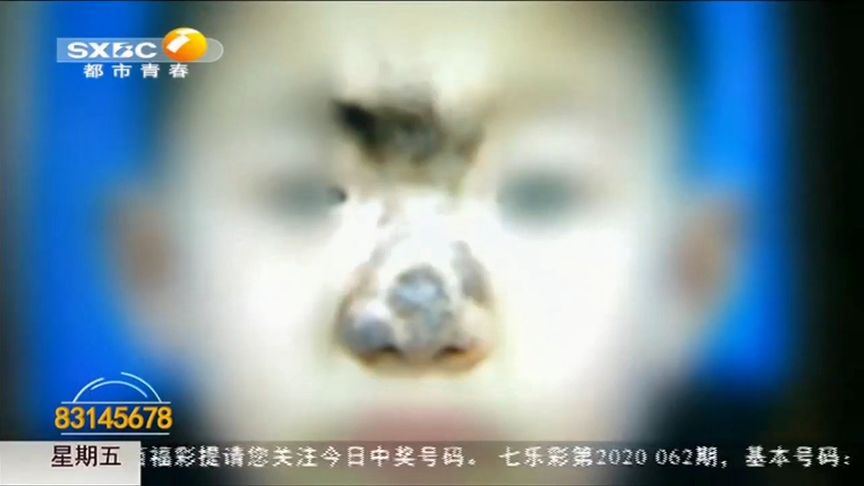 男孩鼻子上长巨痣,三次手术终去除,男孩一句话让人心疼|都市快报