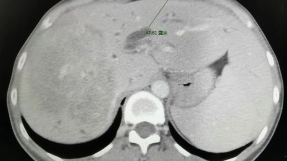 CT引导& DSA验证 PTC 短平快操作!#胆道梗阻