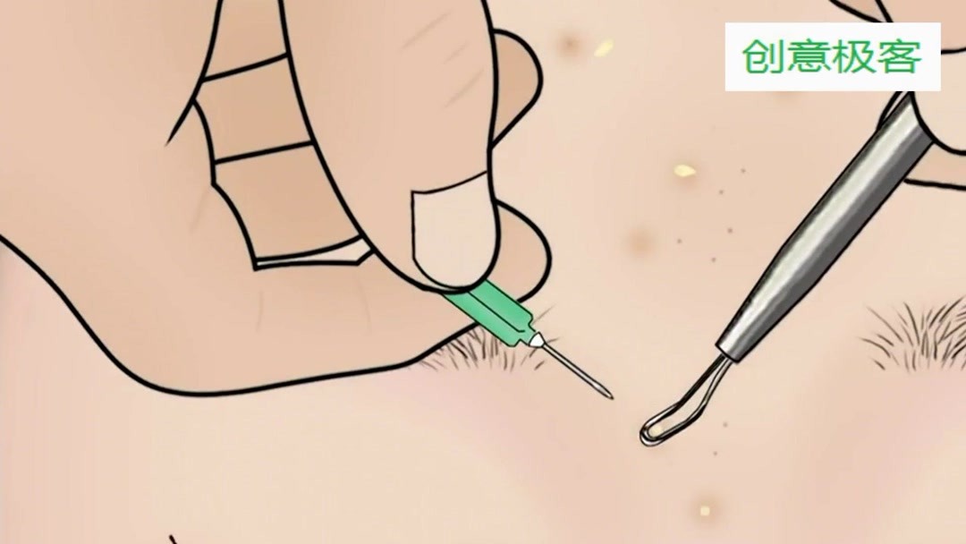 创意极客,手绘定格动画,挤痤疮和黑头清理过程