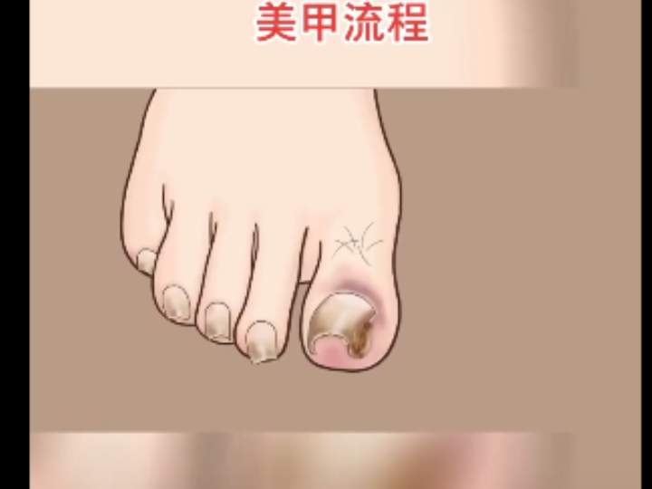 解压游戏:清理发黑的脚趾头