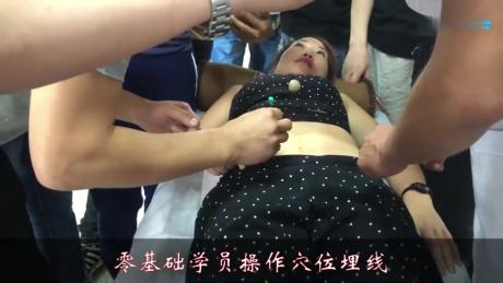 穴位埋线手法视频