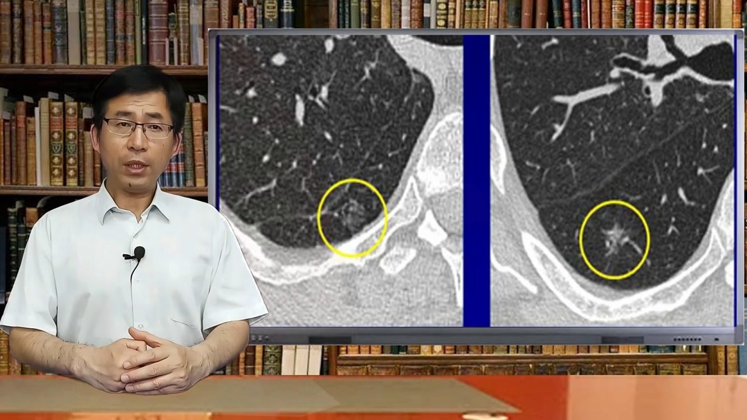 肺结节如果有这九个特征,强烈建议做手术,越早效果越好