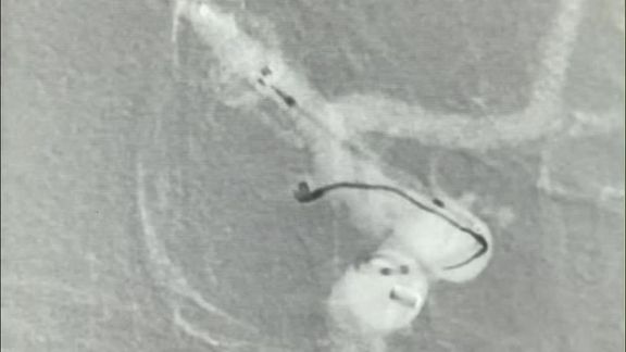 Atlas支架释放 #颅内动脉瘤 #神经介入 #手术