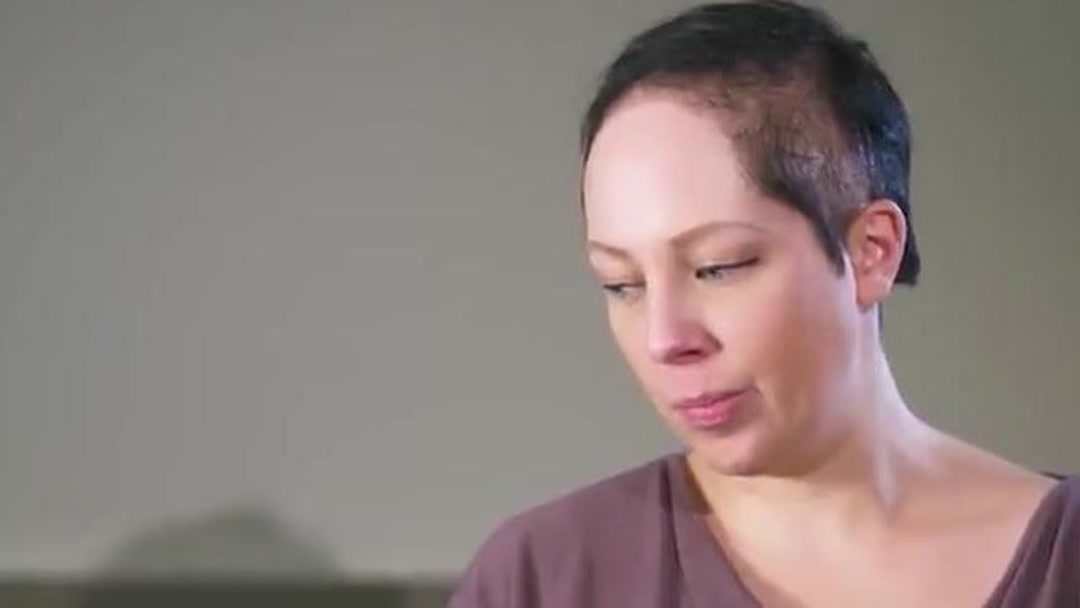 美女患扯头发强迫症 如今变成秃子!