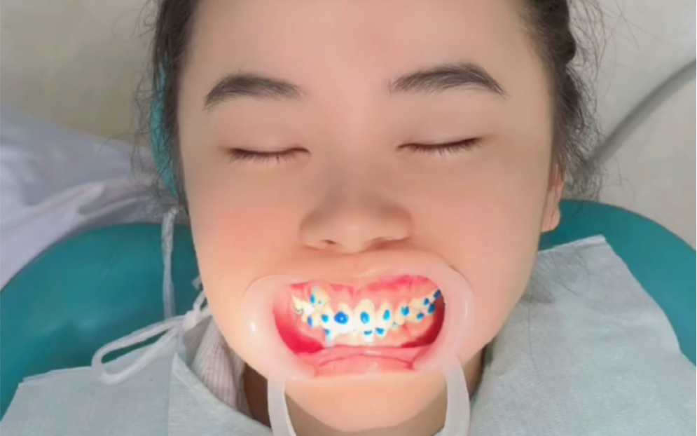 记录整个正畸的过程,拔掉了4颗牙齿,吃东西只能用大牙,每天至少刷3次...