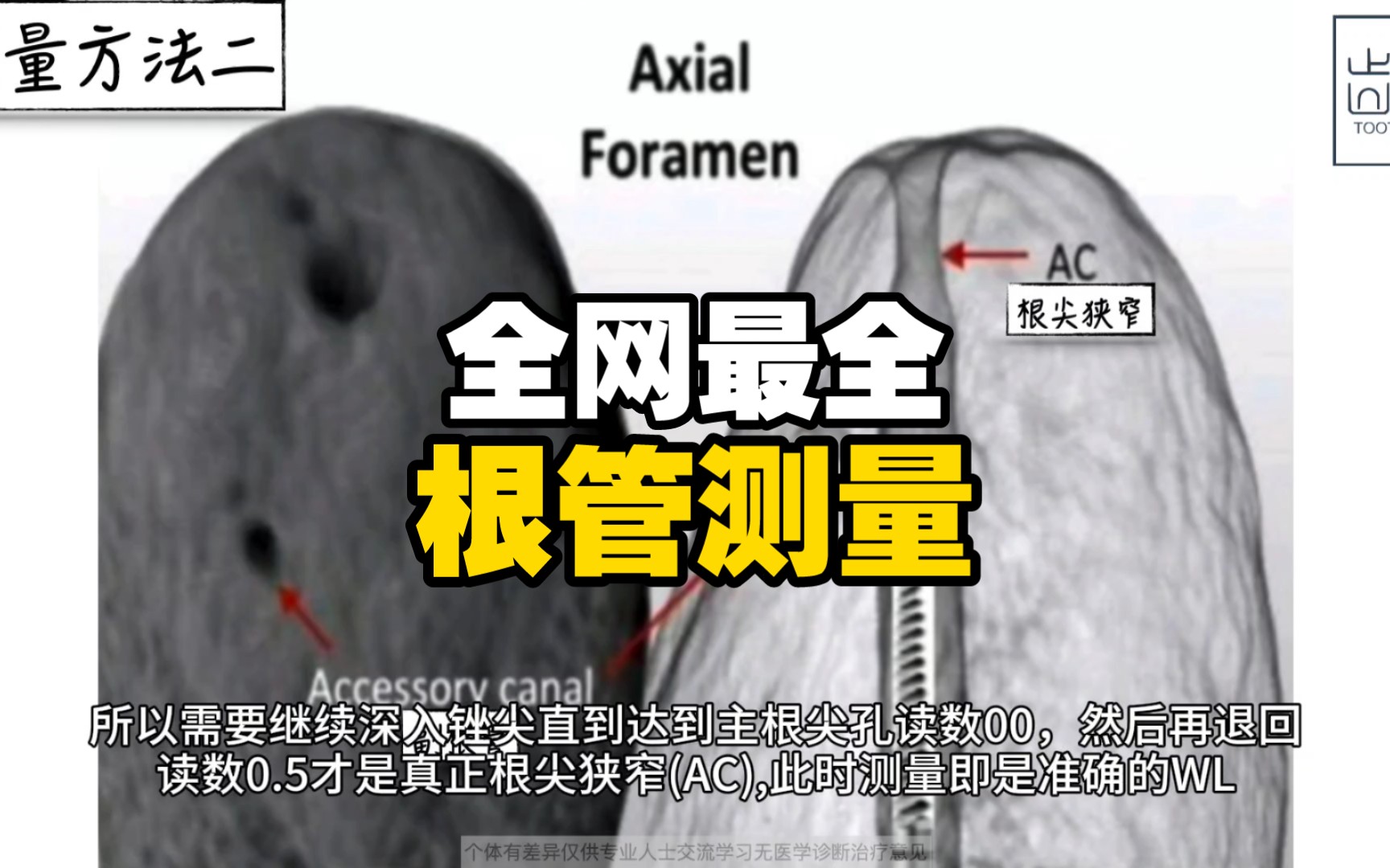 很多人搞错,根测仪测量根管长度一次讲清楚,附最新观点前沿阅读