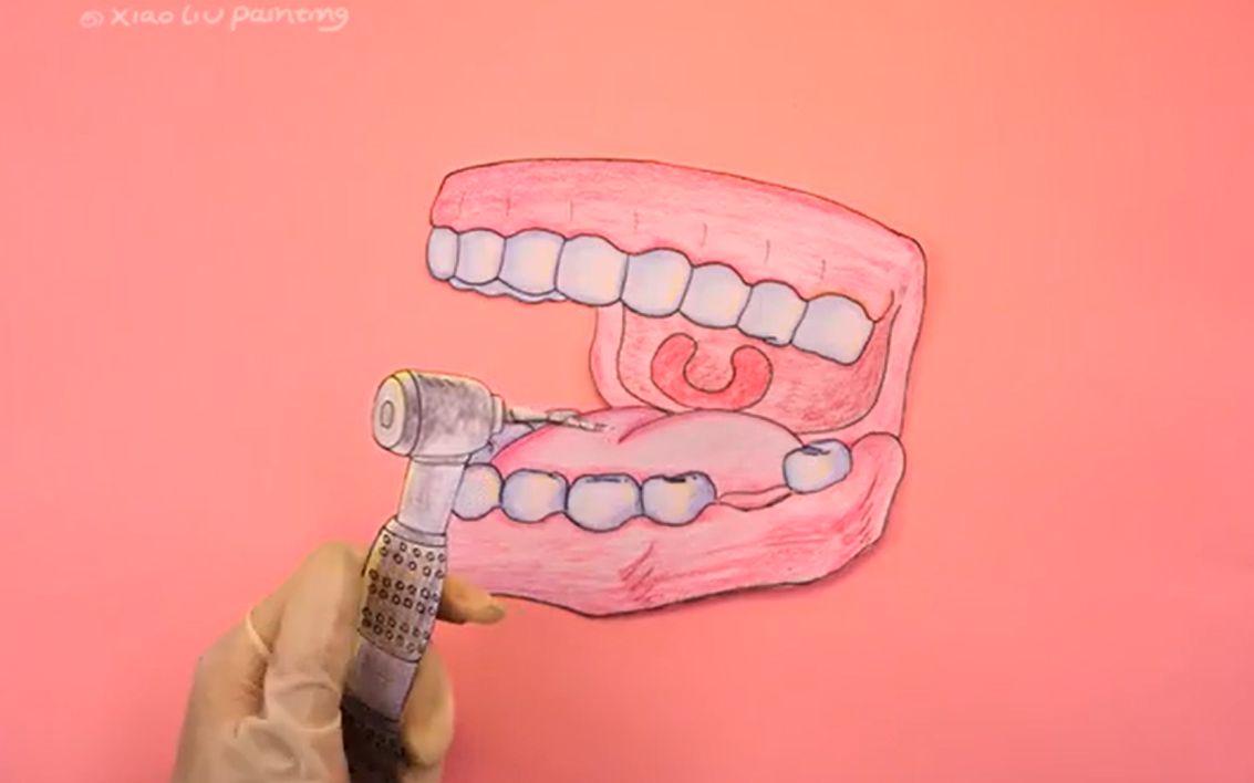 【种植牙】趣味定格动画,3分钟带你了解种植牙全过程