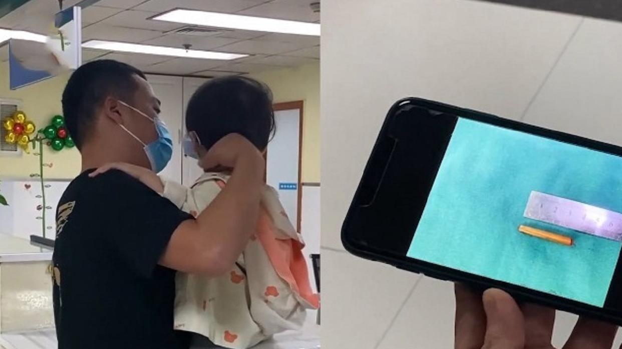 看好孩子!2岁女童摔倒筷子从鼻腔插进眼眶