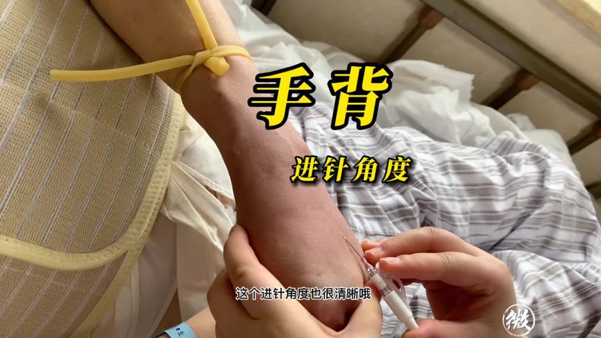 留置针穿刺日常分享…手背,进针角度。其实前臂那儿也挺好的