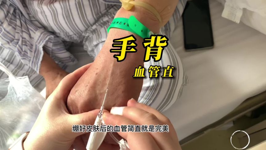 留置针穿刺日常分享…手背,血管直#留置针 #护士