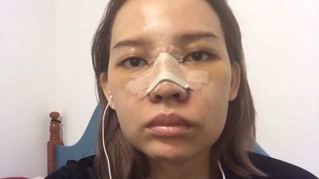 隆鼻恢复全记录,超真实手术前后全过程分享,直呼简直像换了张脸