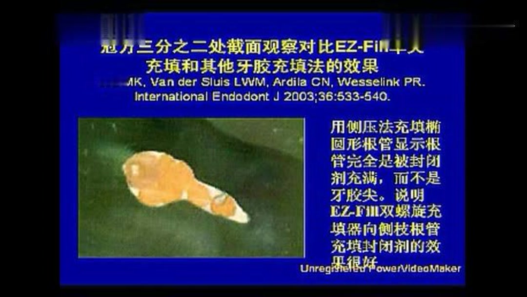 口腔根管治疗--根管充填