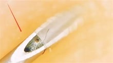 注射器针头进入皮肤的画面,用显微镜放大100倍,过程看着很刺激