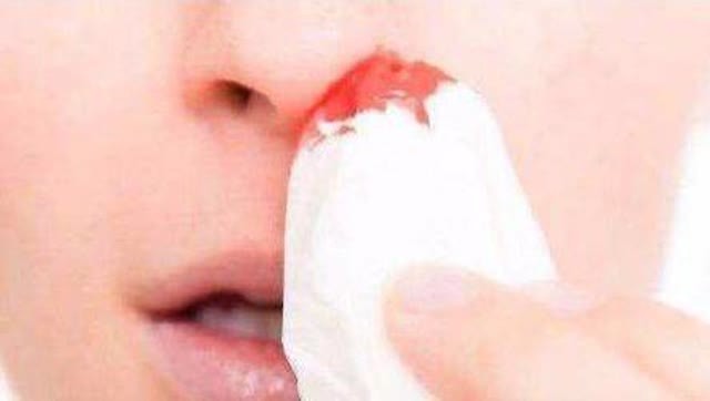 流鼻血停不下来?只需一招,1分钟快速止鼻血,快告诉身边朋友