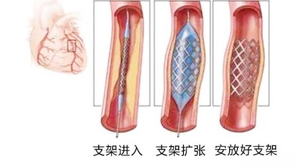 为什么心脏支架术后,一定要吃药?快转给上了支架的人看一看