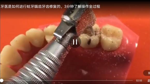 牙医是如何进行蛀牙修复的,三分钟了解操作全过程