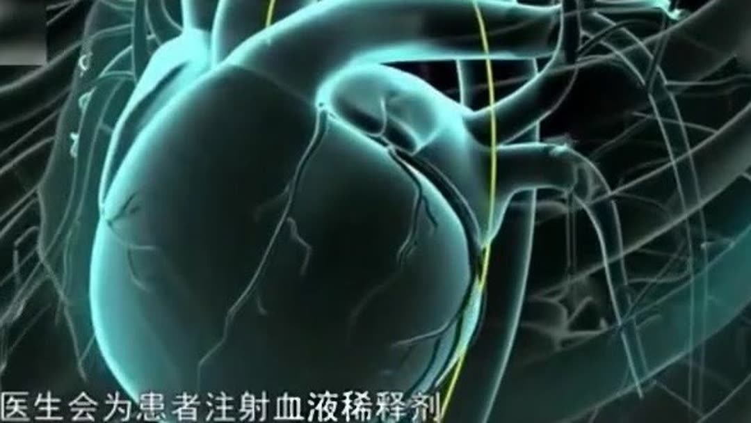 3D演示-心脏支架手术